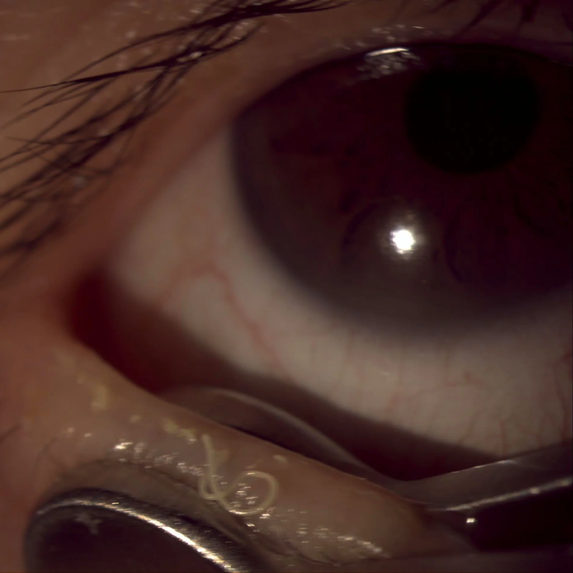 Meibomian Gland Dysfunction — CCLS - Cornea & Contact Lens Society