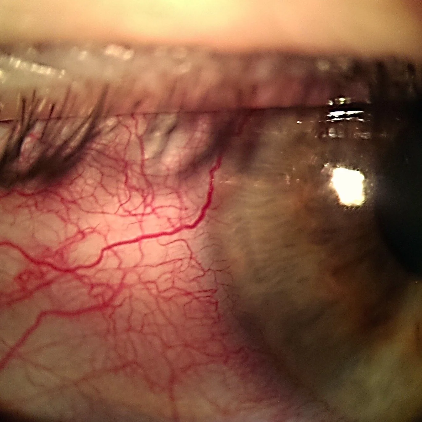 Keratitis / Keratoconjunctivitis — CCLS - Cornea & Contact Lens Society