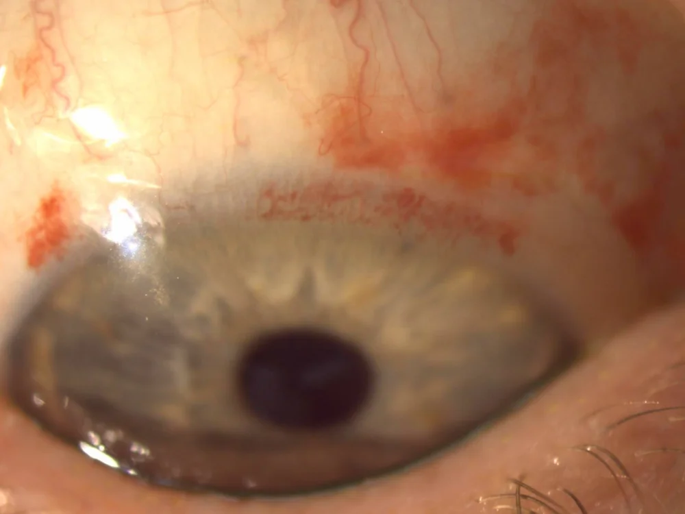 Subconjunctival Haemorrhage — CCLS - Cornea & Contact Lens Society