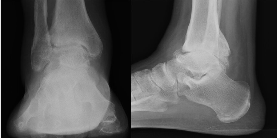 Ankle Arthritis — Chicago Foot And Ankle Orthopaedic Surgeons