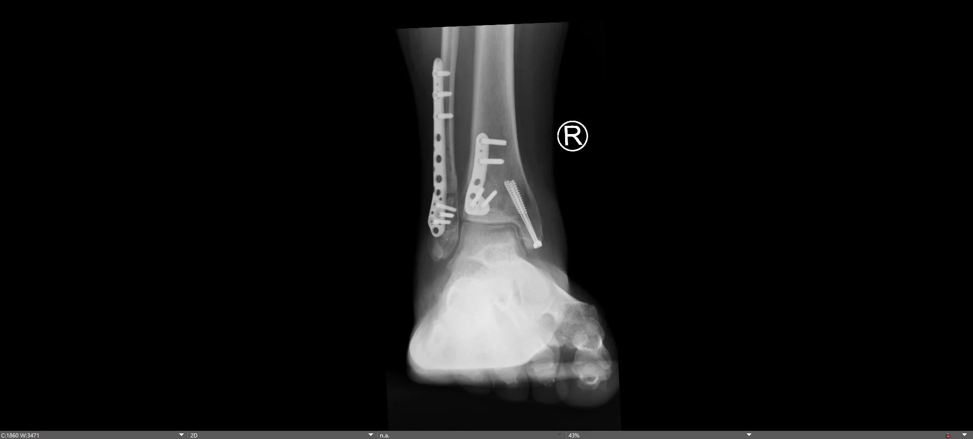 Trimalleolar Ankle Fracture Chicago Foot Ankle Orthopaedic Surgeons