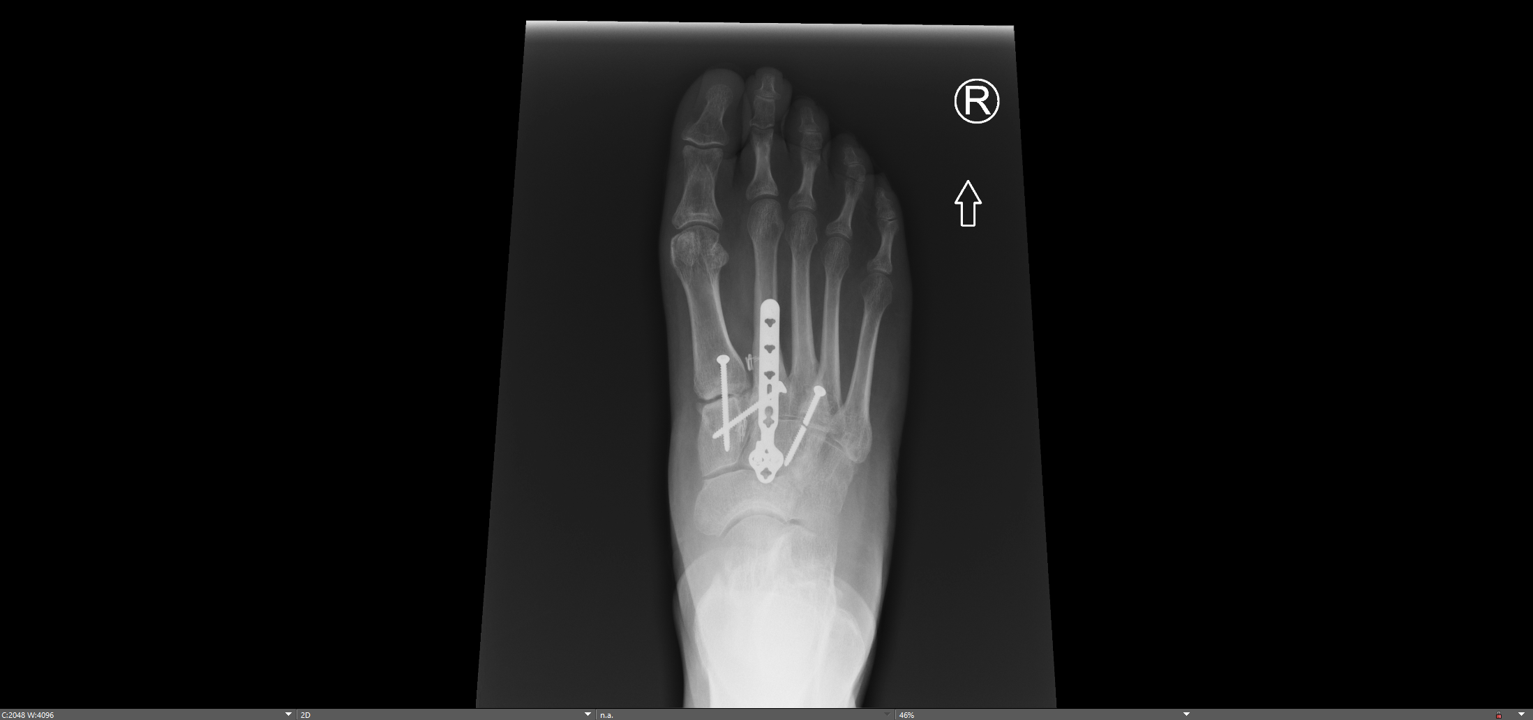 Revision Fusion Of Midfoot Failed LisFranc ORIF Chicago Foot Revision Fusion Of Midfoot Failed LisFranc ORIF Chicago Foot