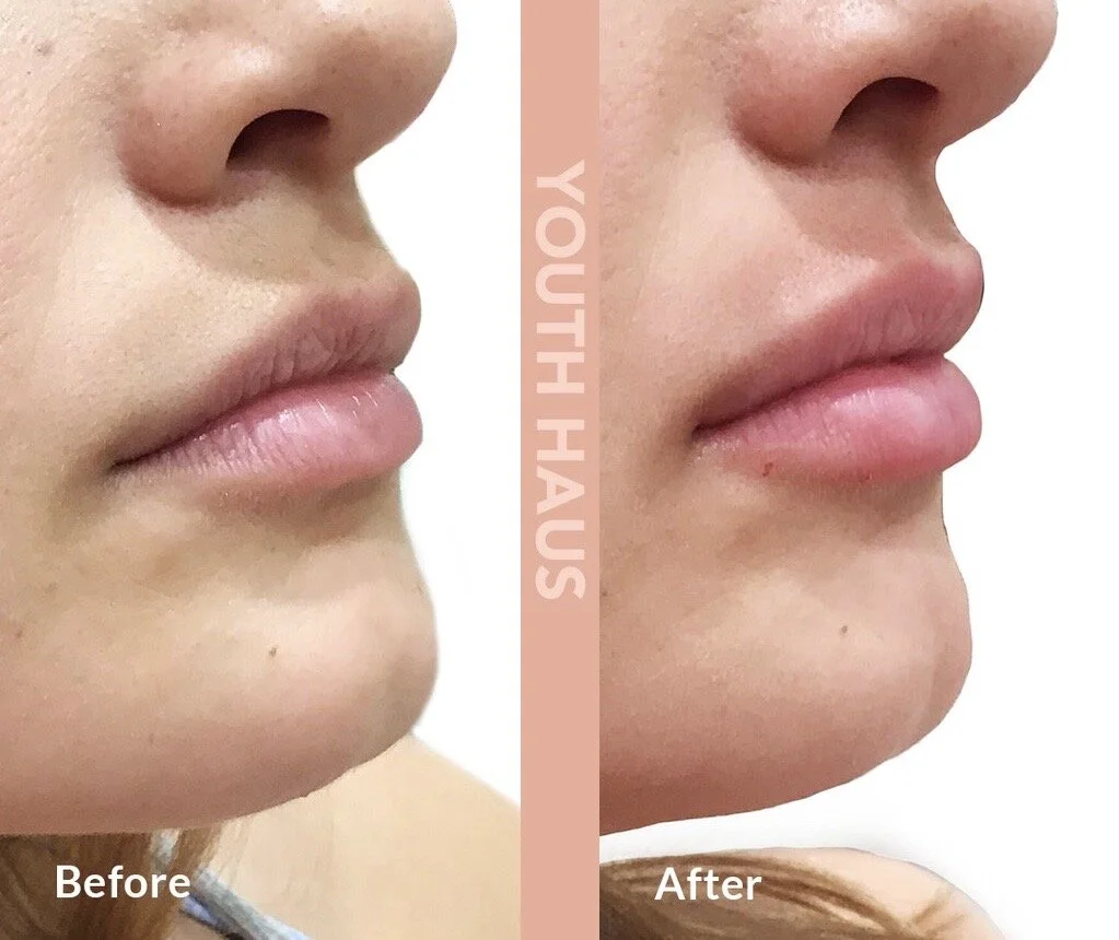 Juvederm Lips Before And After Pics | Lipstutorial.org