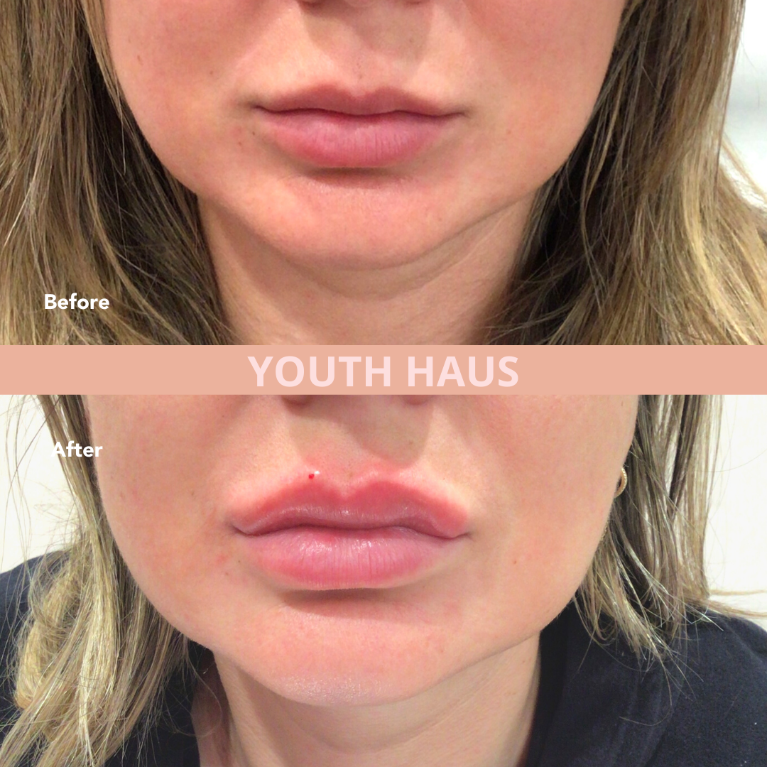 Collagen Injection For Lips Before And After | Lipstutorial.org