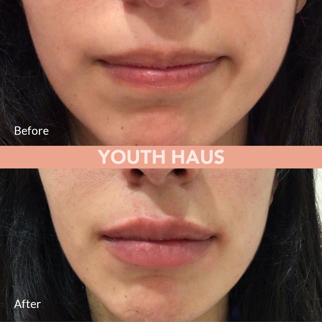 1 Syringe Of Juvederm In Lips Before And After | Lipstutorial.org