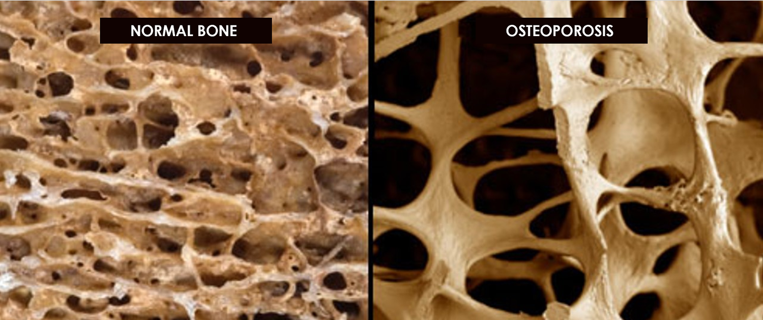 Check Your Knowledge about Bone Health — My Zing Life