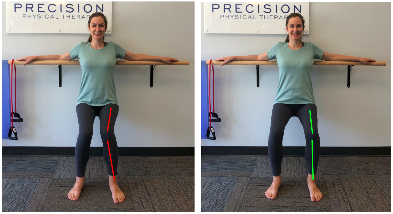 Genu Varum Exercises