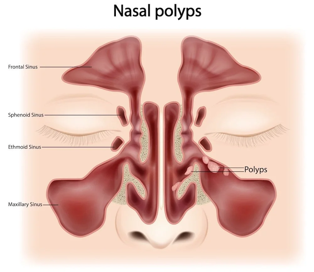 Getting Rid of Nasal Polyps - ENT Center of Excellence
