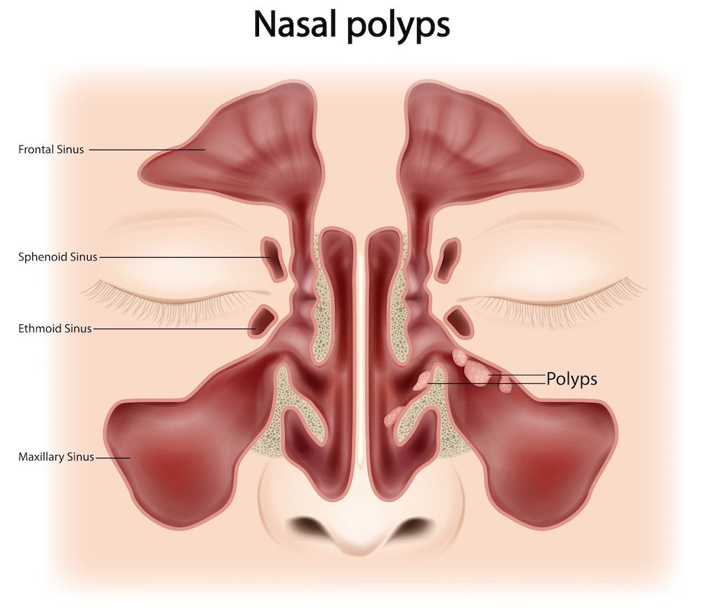 Getting Rid of Nasal Polyps - ENT Center of Excellence