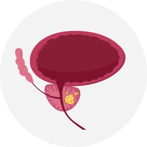 Why treat with Radiotherapy upright? — Leo Cancer Care