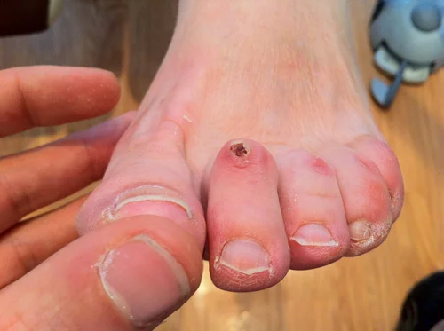 L'Orthoplastie ou orthèse d'orteil — Cabinet de Podologie Raspail Paris ...