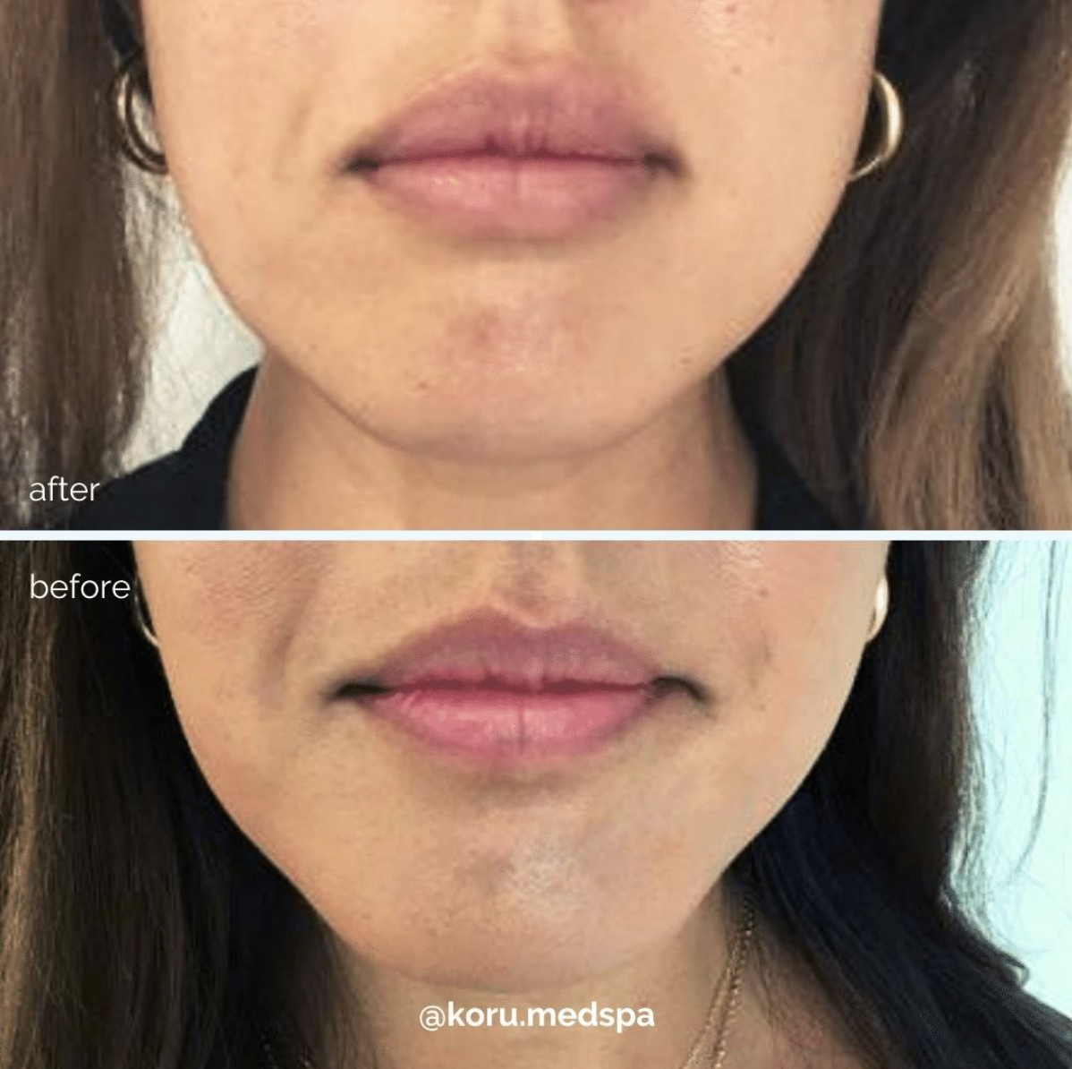 How to Choose The Right Filler — Koru Medical Spa