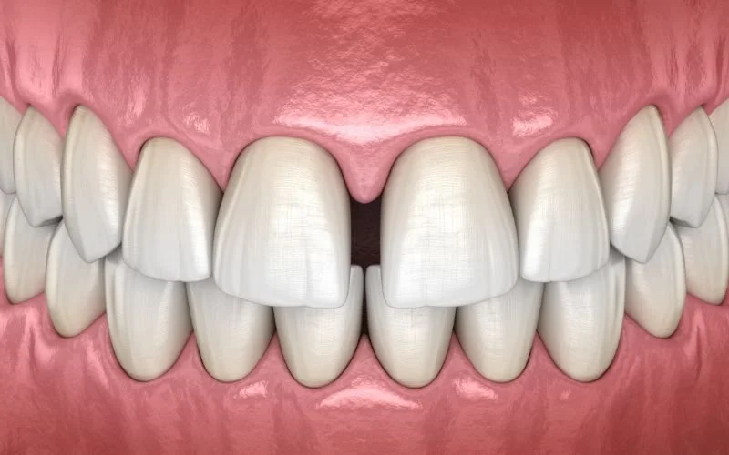 Do you know what a frenectomy is? This is everything you need to know ...