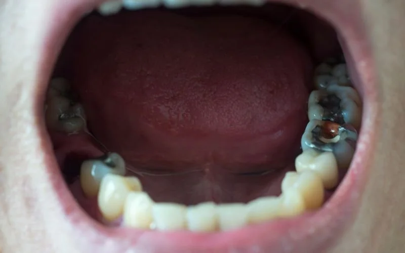 Dental Nerve Treatment: Everything you need to know from the hand of ...