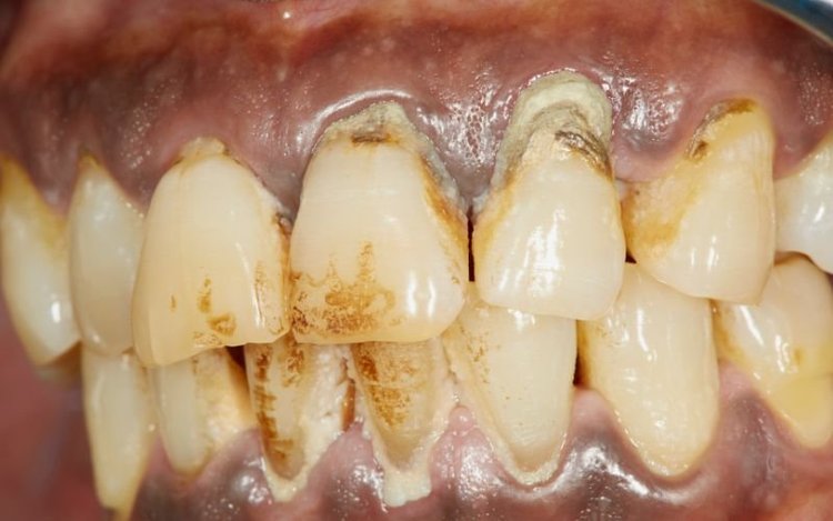 ¿What is periodontal disease or periodontitis? — ProDent