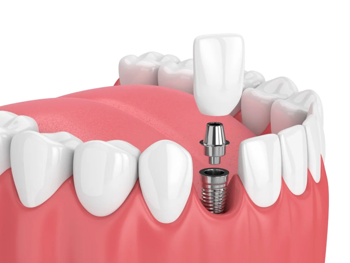 Implants — London Dental Centre