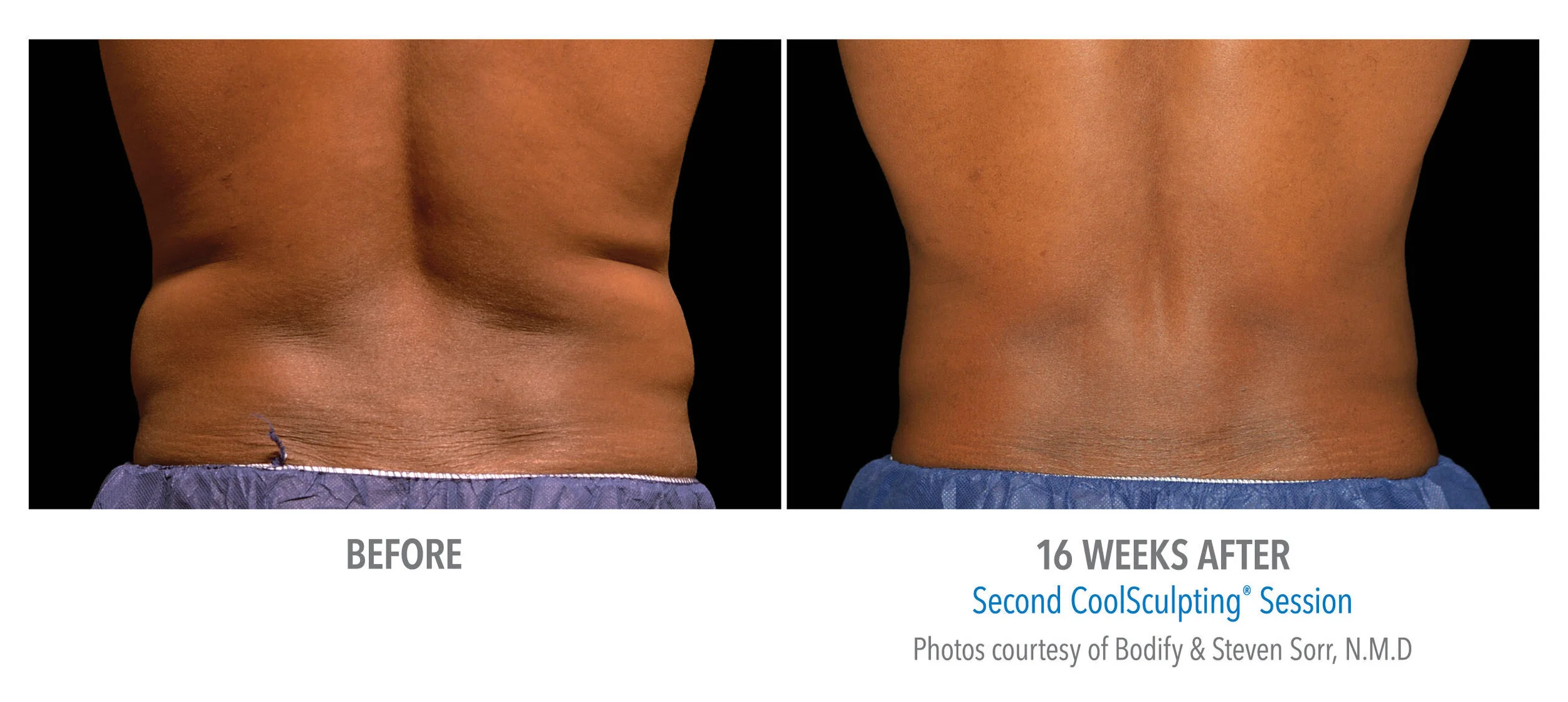 Coolsculpting Recovery & Treatment | Coolsculpting Fat Freezing ...