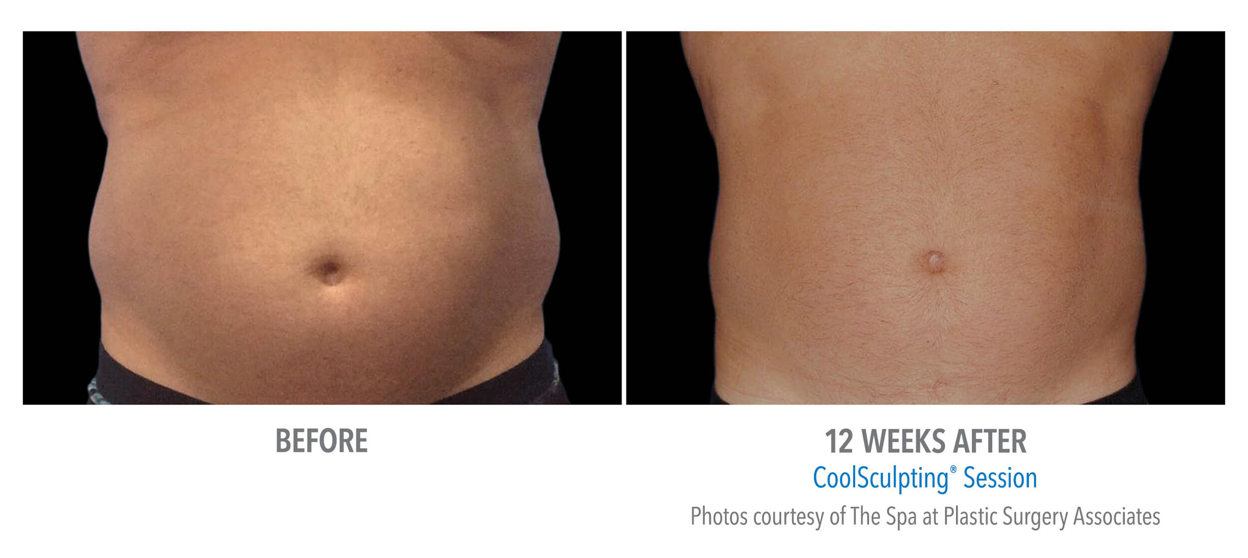 Coolsculpting Treatment & Clinic in Naperville, IL - Contour Medspa ...