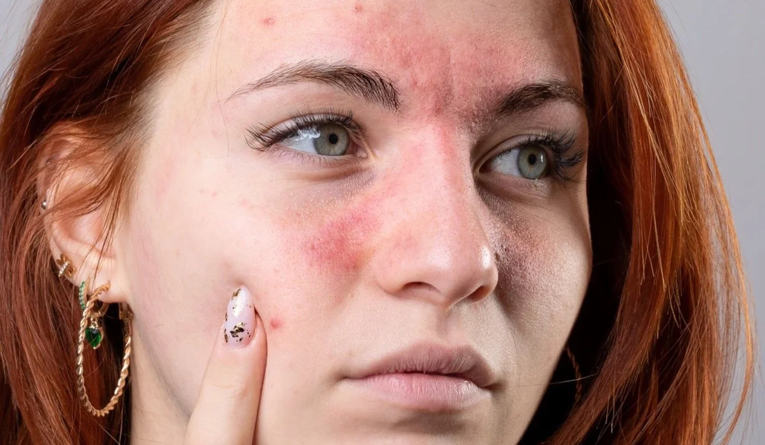 Side effects of Accutane — Medical Secrets
