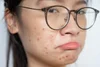 Side effects of Accutane — Medical Secrets