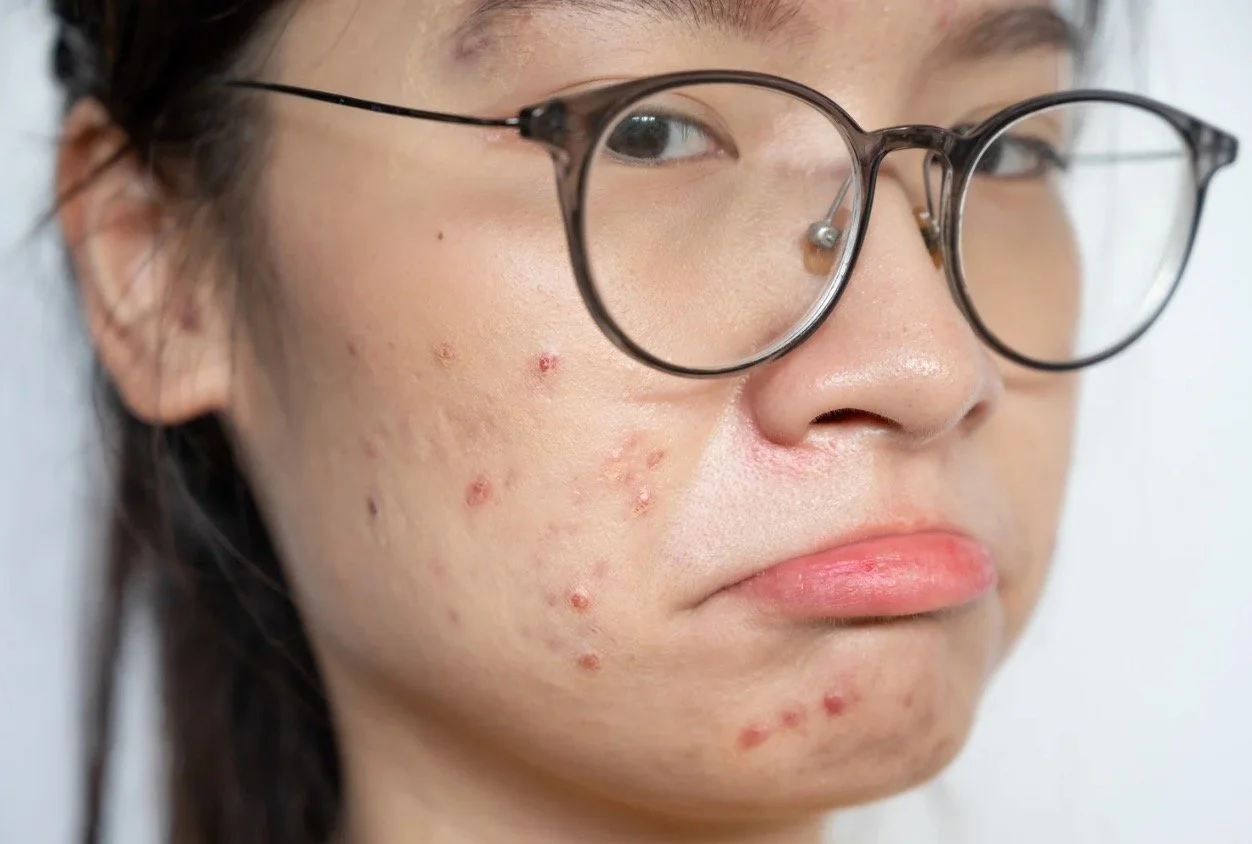 Side effects of Accutane — Medical Secrets