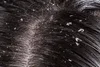 Dandruff (Itchy Scalp) — Medical Secrets