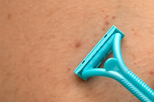 Folliculitis (razor burn) — Medical Secrets