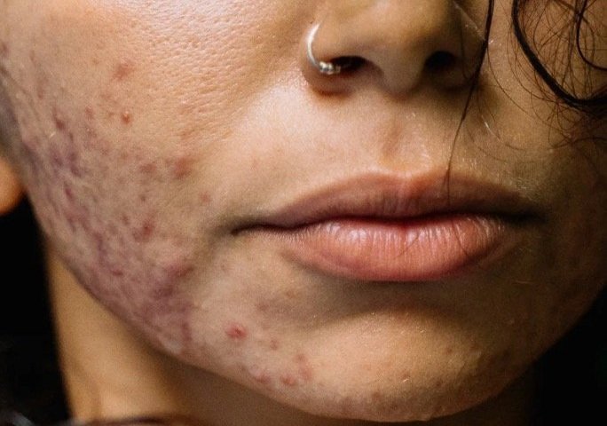 Acne — Medical Secrets