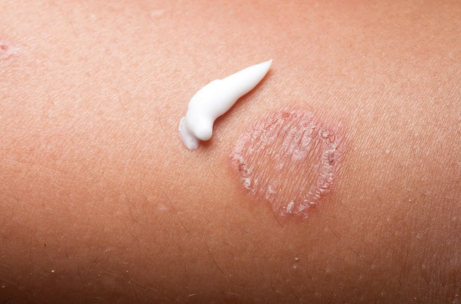 Ringworm — Medical Secrets