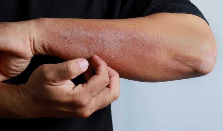 Side effects of Accutane — Medical Secrets