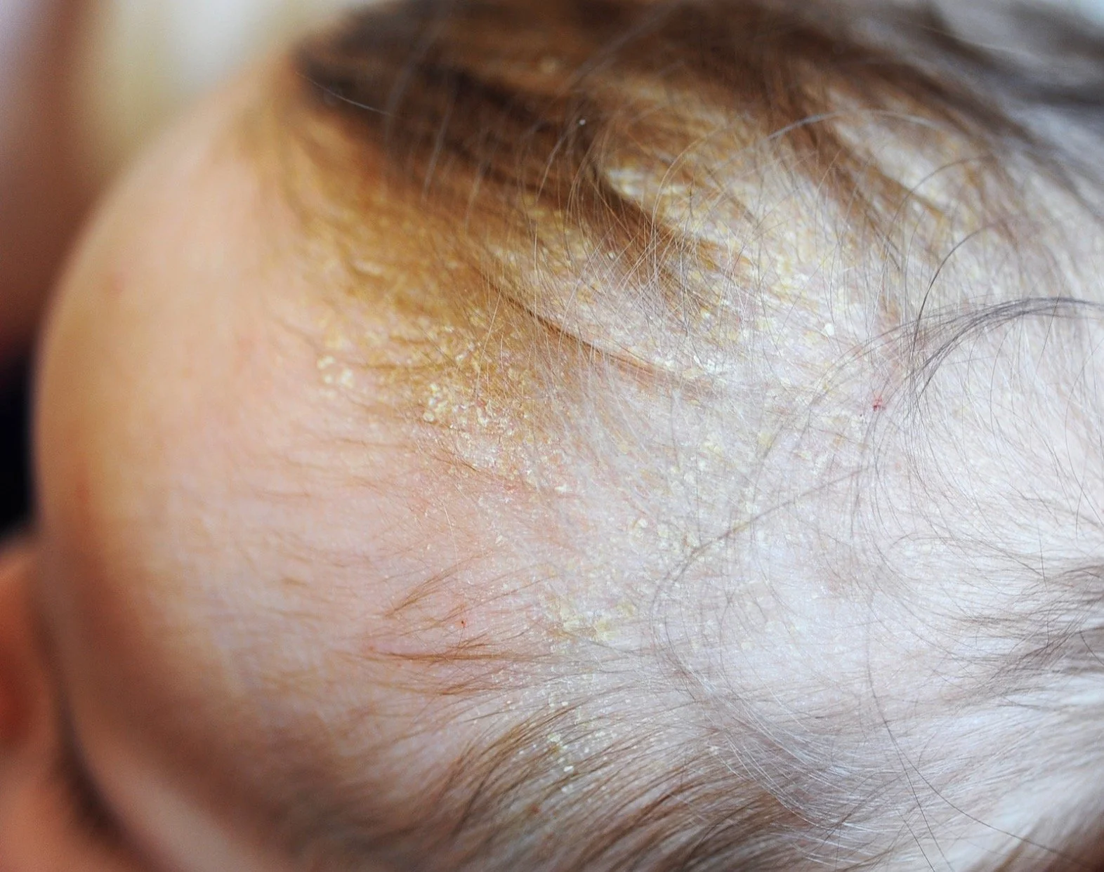 Cradle Cap (Seborrheic Dermatitis) — Medical Secrets