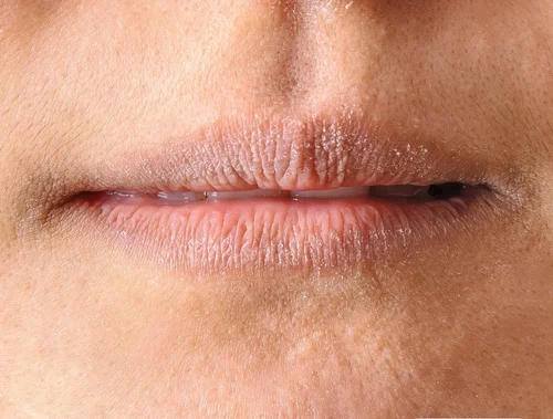 Lip Licker's Eczema (Dermatitis) — Medical Secrets