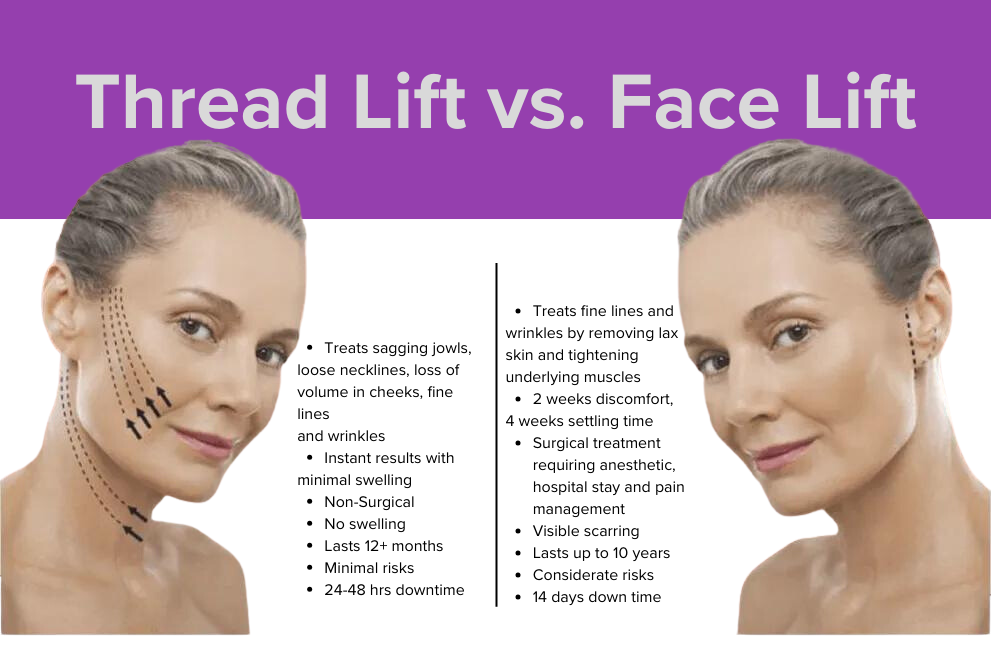 PDO Thread Lift — Aesthetic Solutions