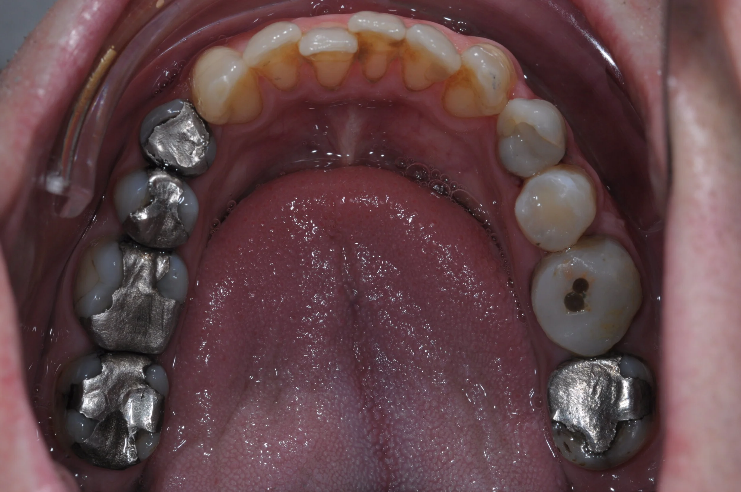 White Fillings — Devine Dental