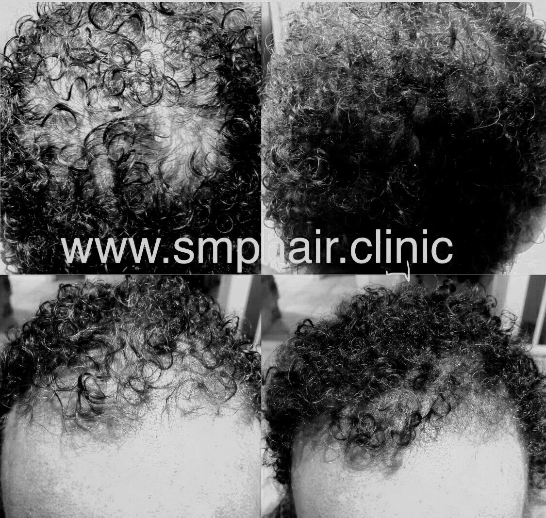 Gallery — SMP HAIR CLINIC
