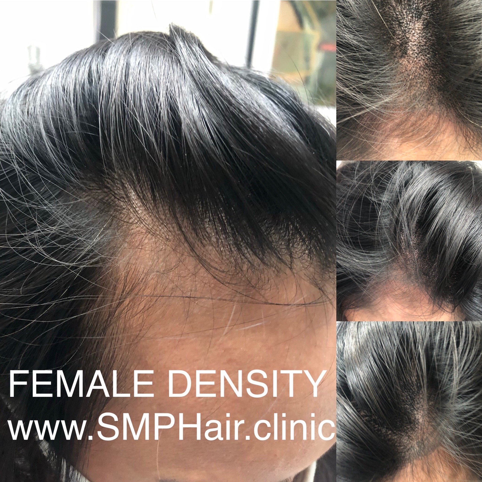 Gallery — SMP HAIR CLINIC