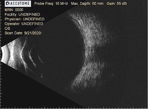 B-Scan Ultrasonography Chicago | University Retina