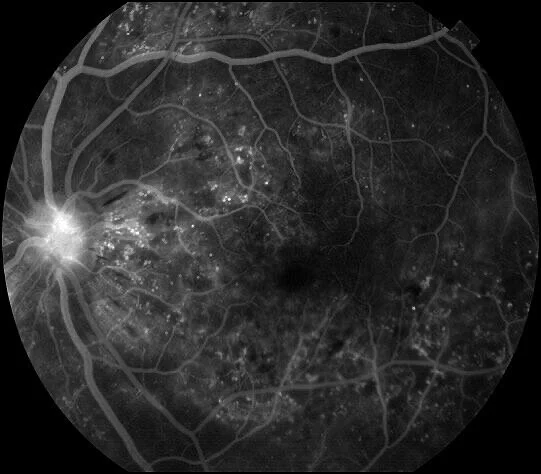 Fluorescein and Indocyanine green (ICG) Angiography Chicago ...
