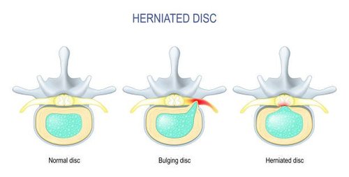 Spinal Discs...What Are They? — Southern Spine & Rehab, PLLC
