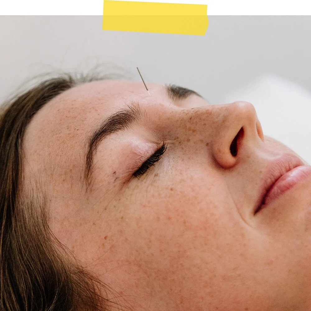 cosmetic acupuncture — wellbe family wellness