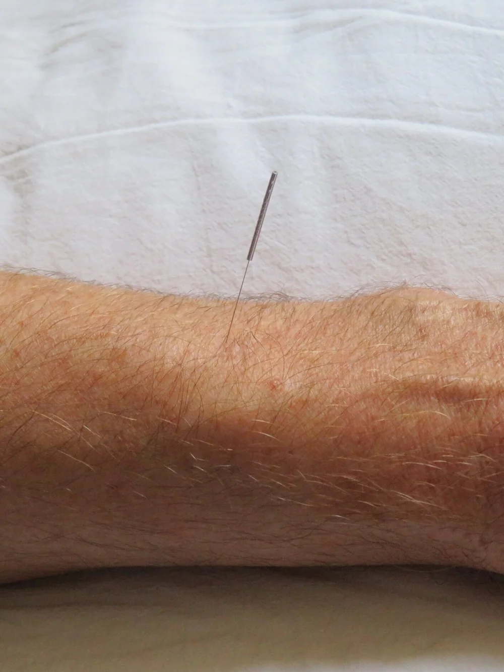 About Acupuncture — Stephen Lock