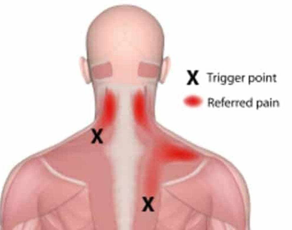 Referred Pain: What Is It How to Treat It, PhysioFocus.com.au — Physio ...