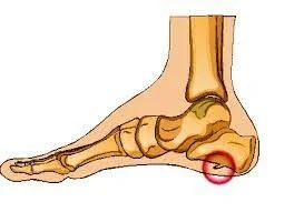 How Serious are Bone Spurs on the Spine? — Nitin Khanna, MD