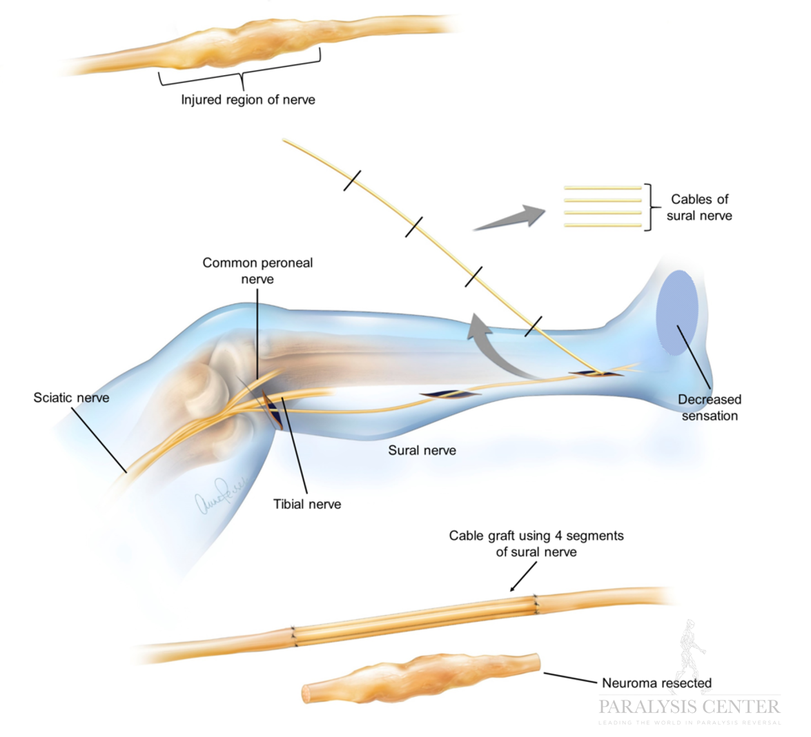 Nerve Graft — Paralysis Center