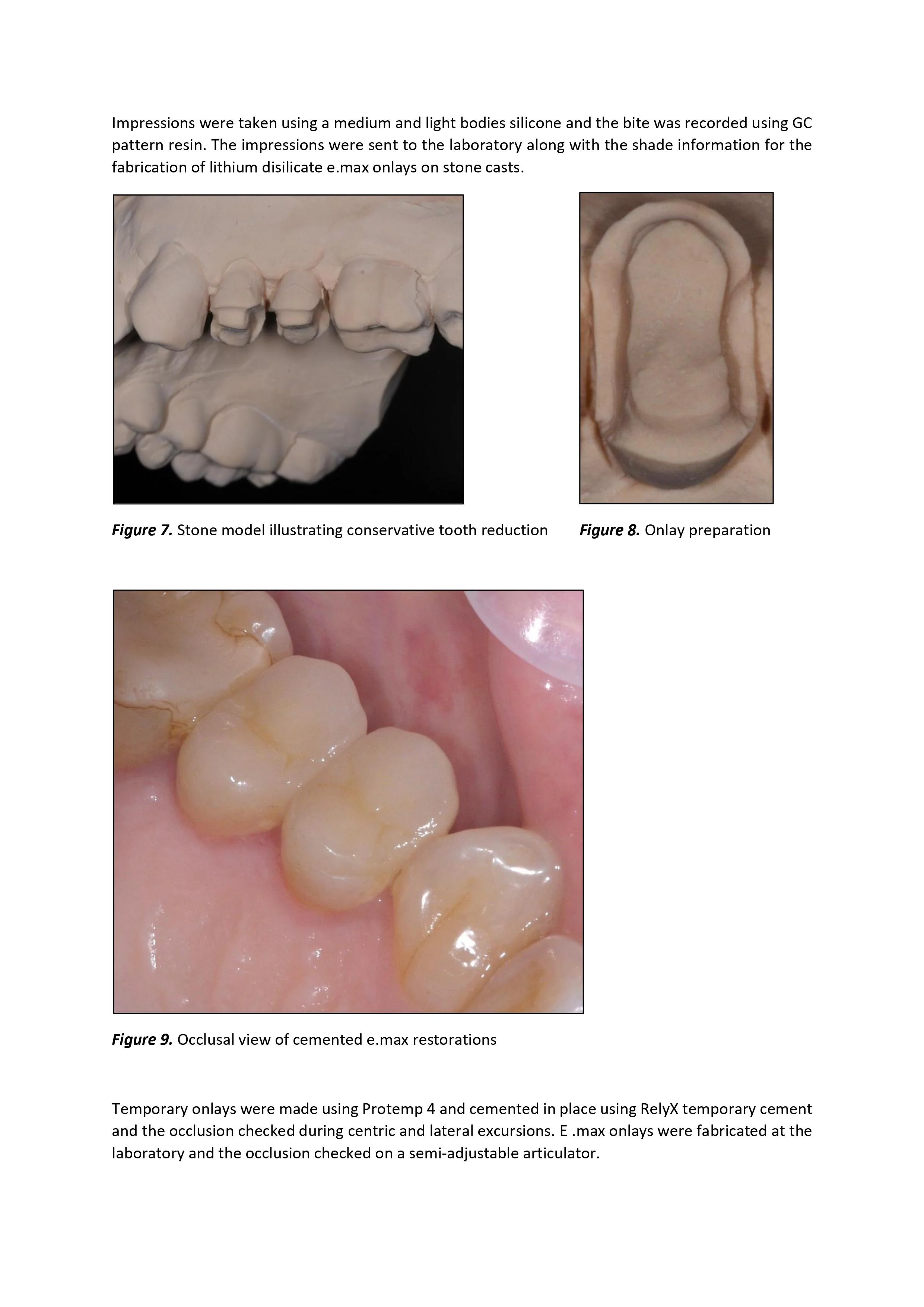 Restoration of endodontically treated premolars with lithium disilicate ...