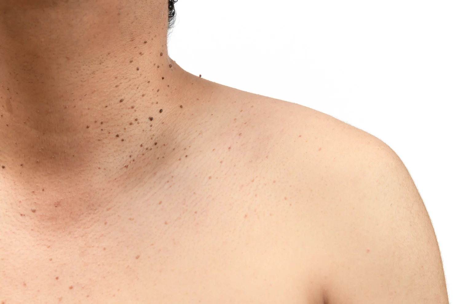 Benign Skin Growths — Luxe Dermatology and Aesthetics