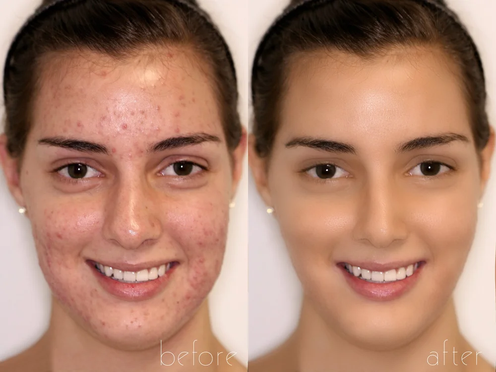 Acid Before And After