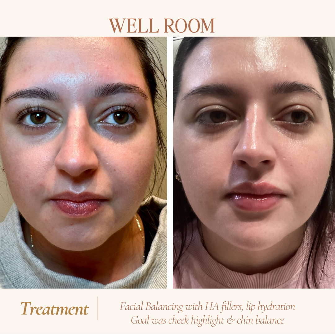 Dermal Filler Specialists in Charlottesville | Well Room Aesthetics ...
