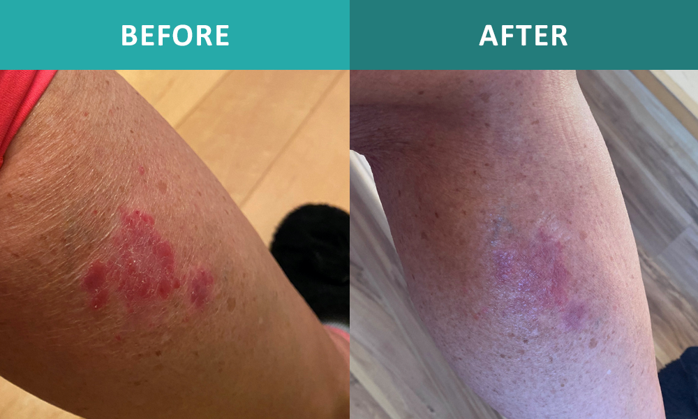 Natural Treatments for Psoriasis | Dermatologist Los Angeles