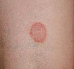 Natural Treatment for Rashes | Dermatologist Los Angeles